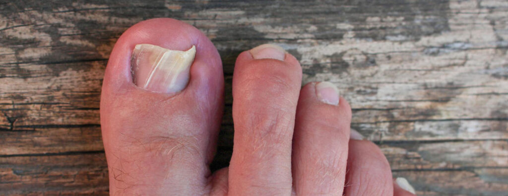 Ingrown Toenails - Dr Shazia Malik Podiatry